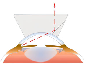 PHFI CEHJ » Gonioscopy skills and techniques
