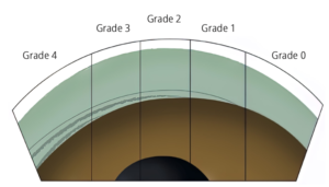PHFI CEHJ » Gonioscopy skills and techniques