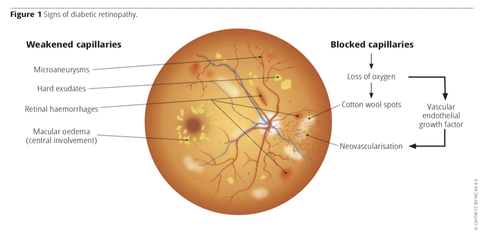 Grading diabetic retinopathy: an introduction - CEHJ, SA Grading diabetic retinopathy: an introduction - CEHJ, SA