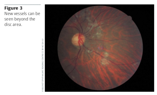 Grading images for diabetic retinopathy: tips and guidelines - CEHJ, SA