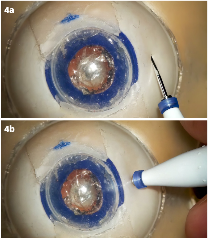 Vitreoretinal surgery: an introduction to simulation training - CEHJ, SA