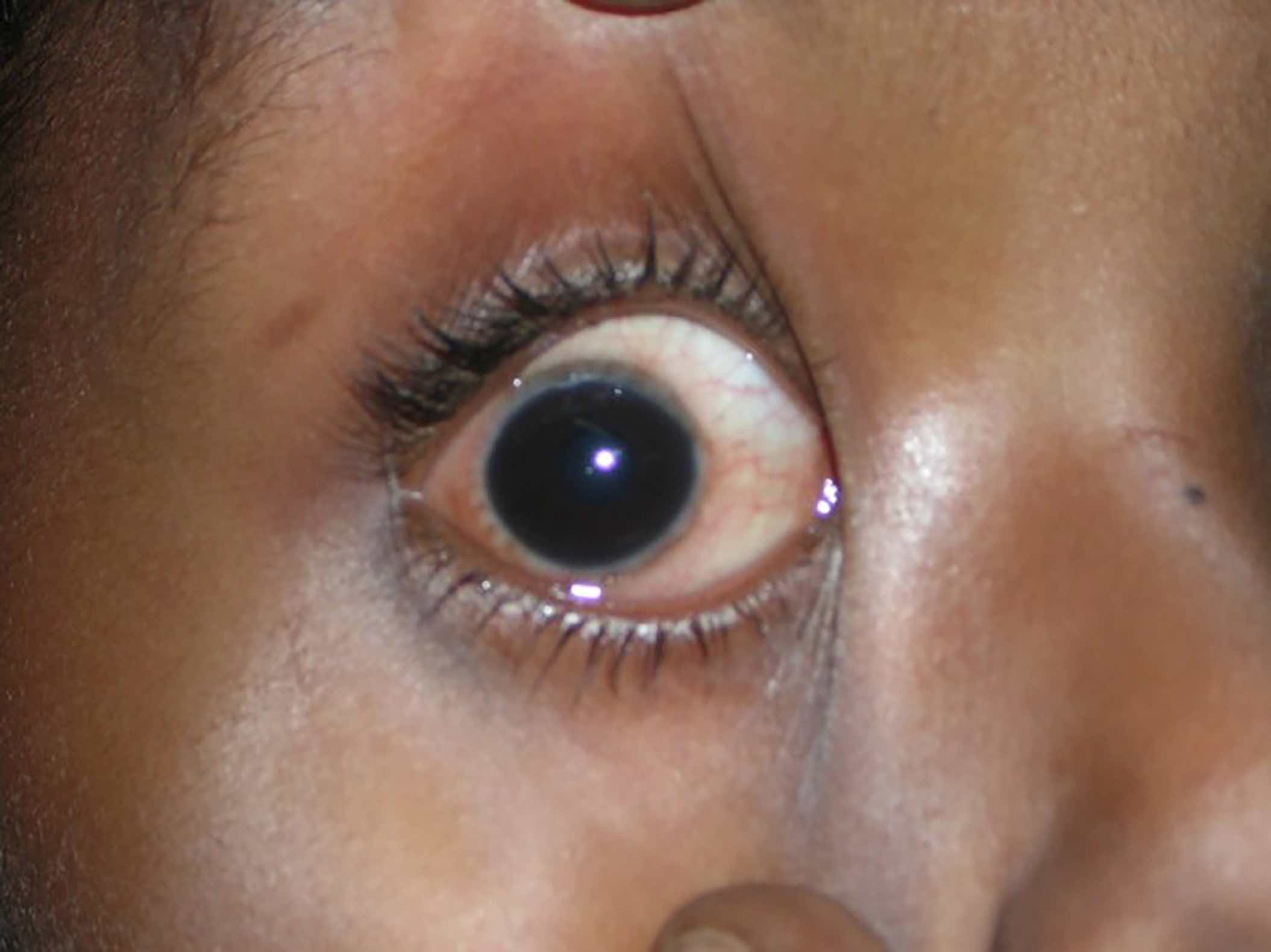 PHFI CEHJ » Common eye conditions in children: care and referral at ...