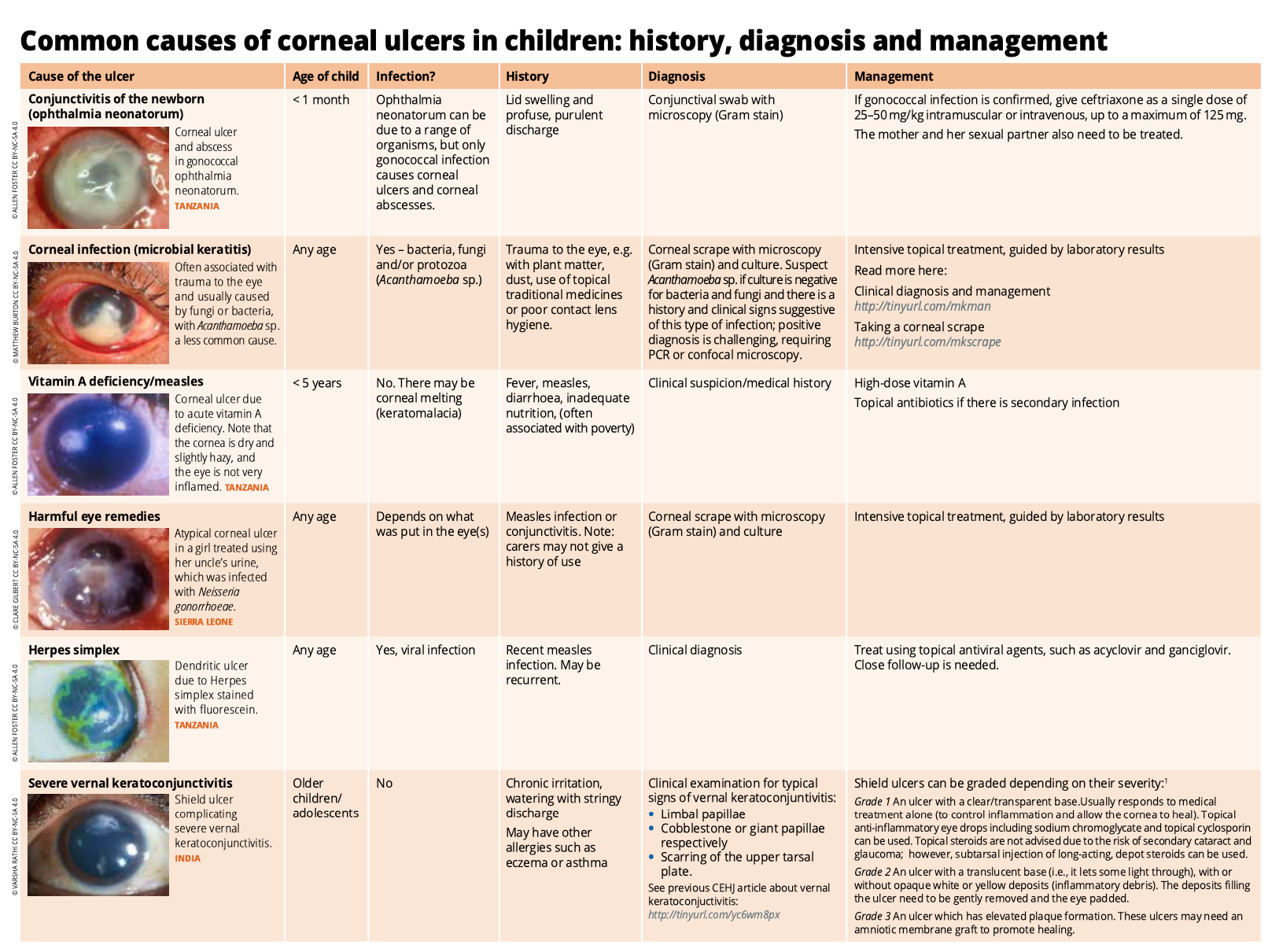 Corneal ulcers in children - CEHJ