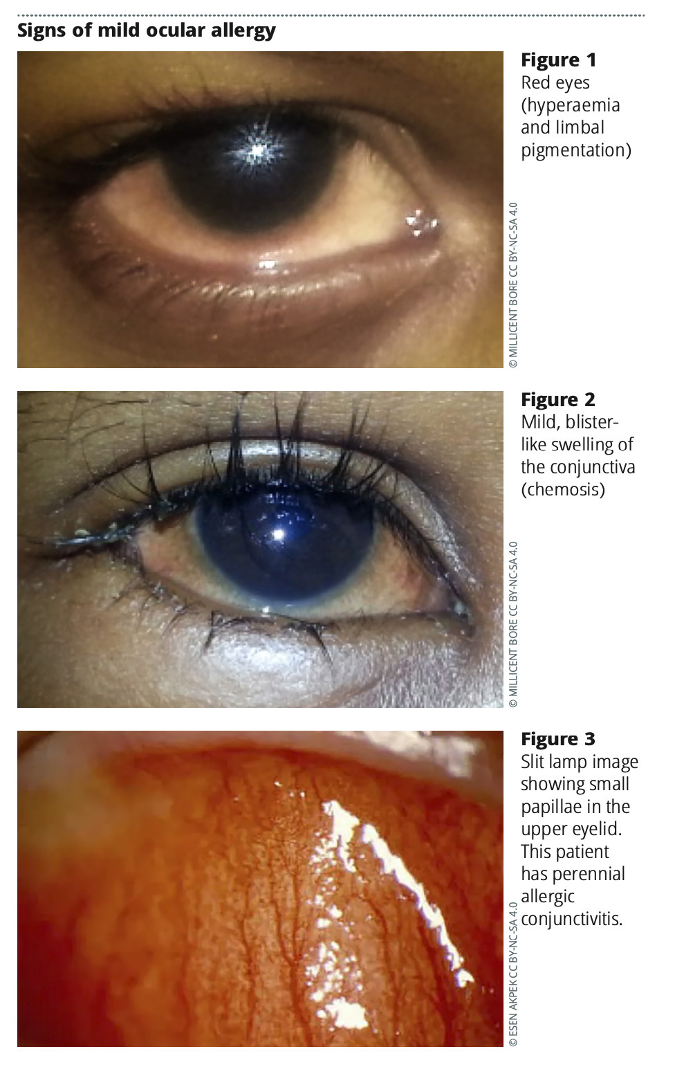 PHFI CEHJ » Managing ocular allergy