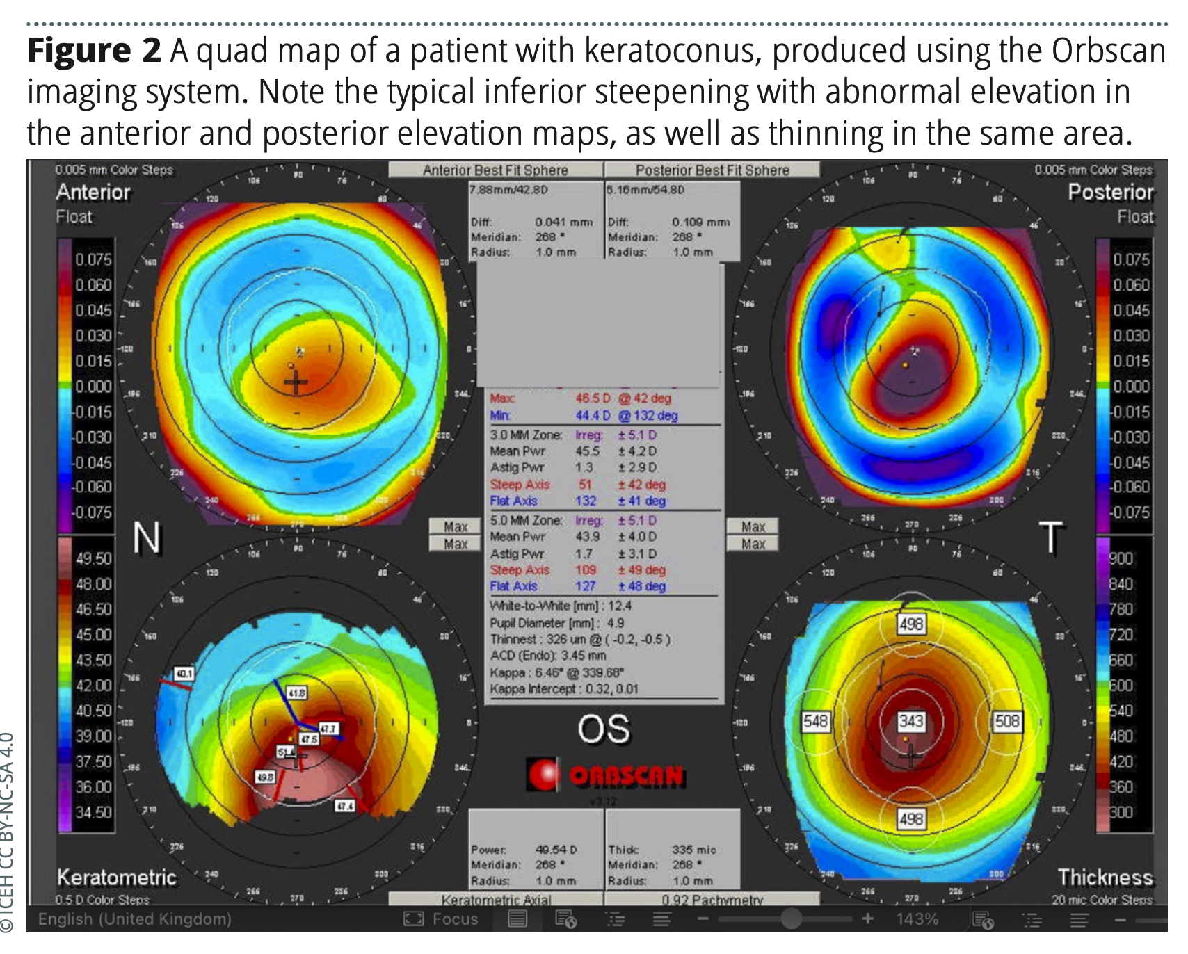 PHFI CEHJ » Keratoconus: diagnosis and management