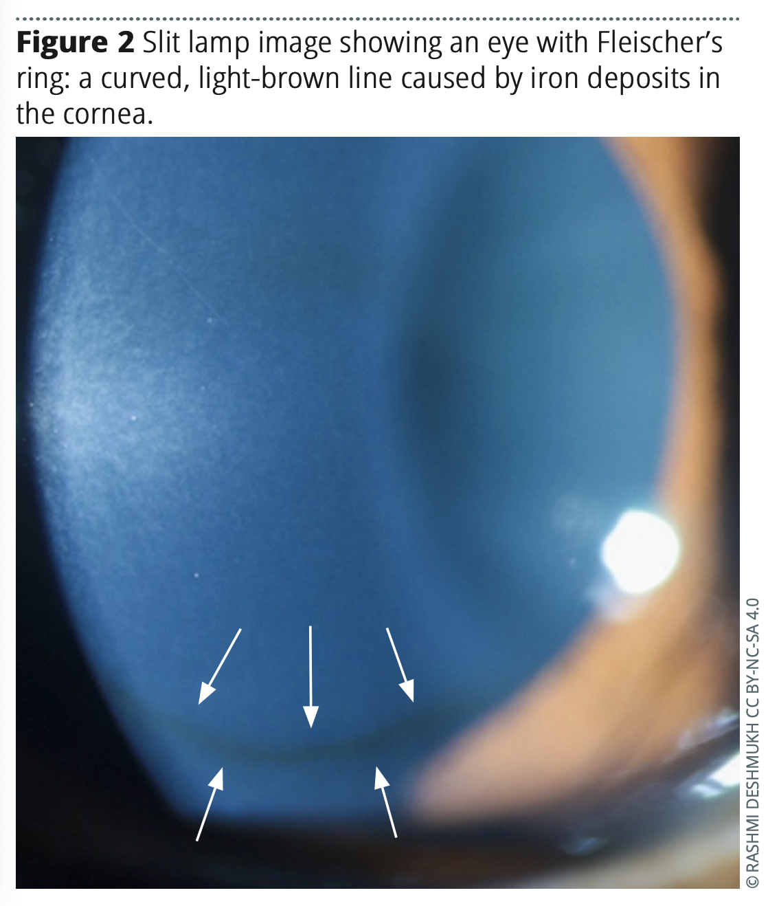 PHFI CEHJ » Keratoconus: an introduction