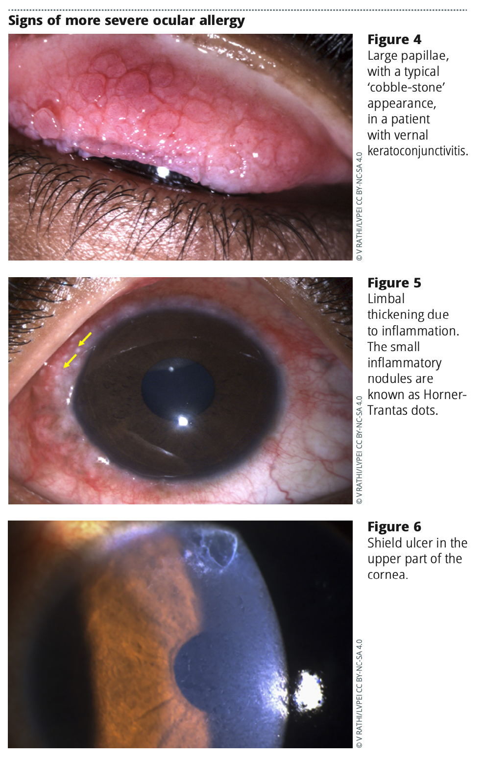 PHFI CEHJ » Managing ocular allergy