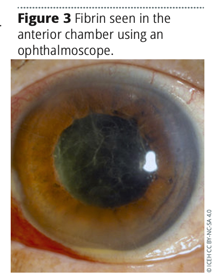 CEHJ » Diagnosing microbial keratitis in different settings
