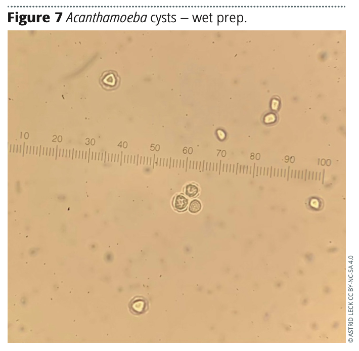 CEHJ » Diagnosing microbial keratitis in different settings
