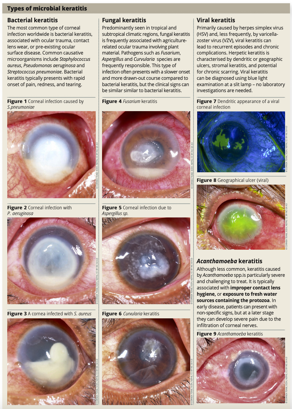 CEHJ » Diagnosing microbial keratitis in different settings