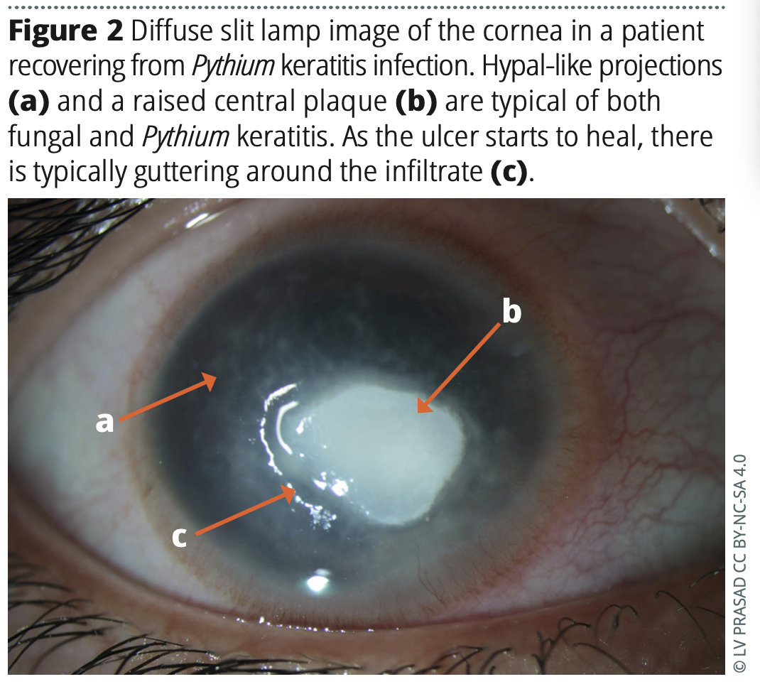 PHFI CEHJ » Pythium insidiosum: the organism that mimics fungal keratitis