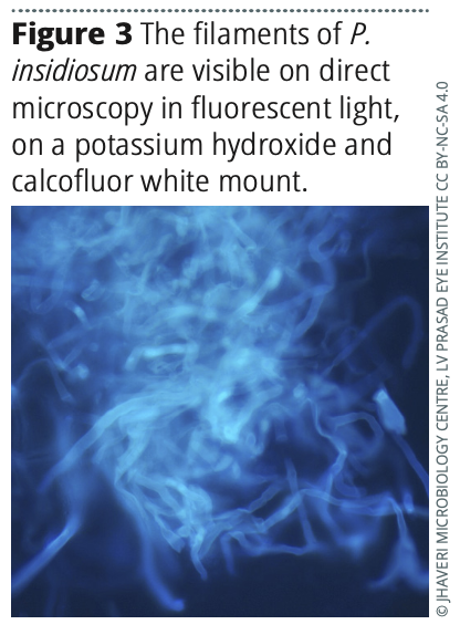 PHFI CEHJ » Pythium insidiosum: the organism that mimics fungal keratitis