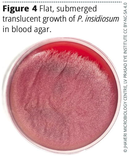 PHFI CEHJ » Pythium insidiosum: the organism that mimics fungal keratitis