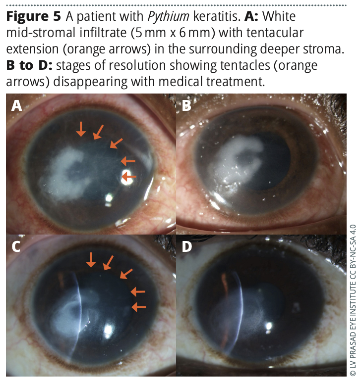 PHFI CEHJ » Pythium insidiosum: the organism that mimics fungal keratitis