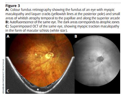 Management of myopic traction maculopathy - CEHJ, SA