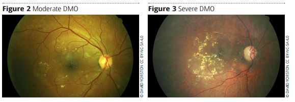 Diabetic macular oedema (DMO): an introduction - CEHJ, SA