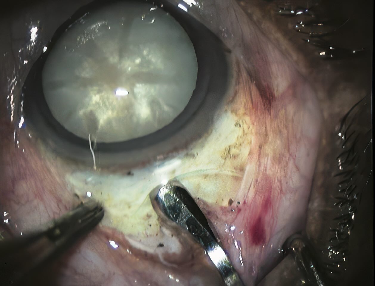 Manual small-incision cataract surgery (MSICS): techniques and tips to ...