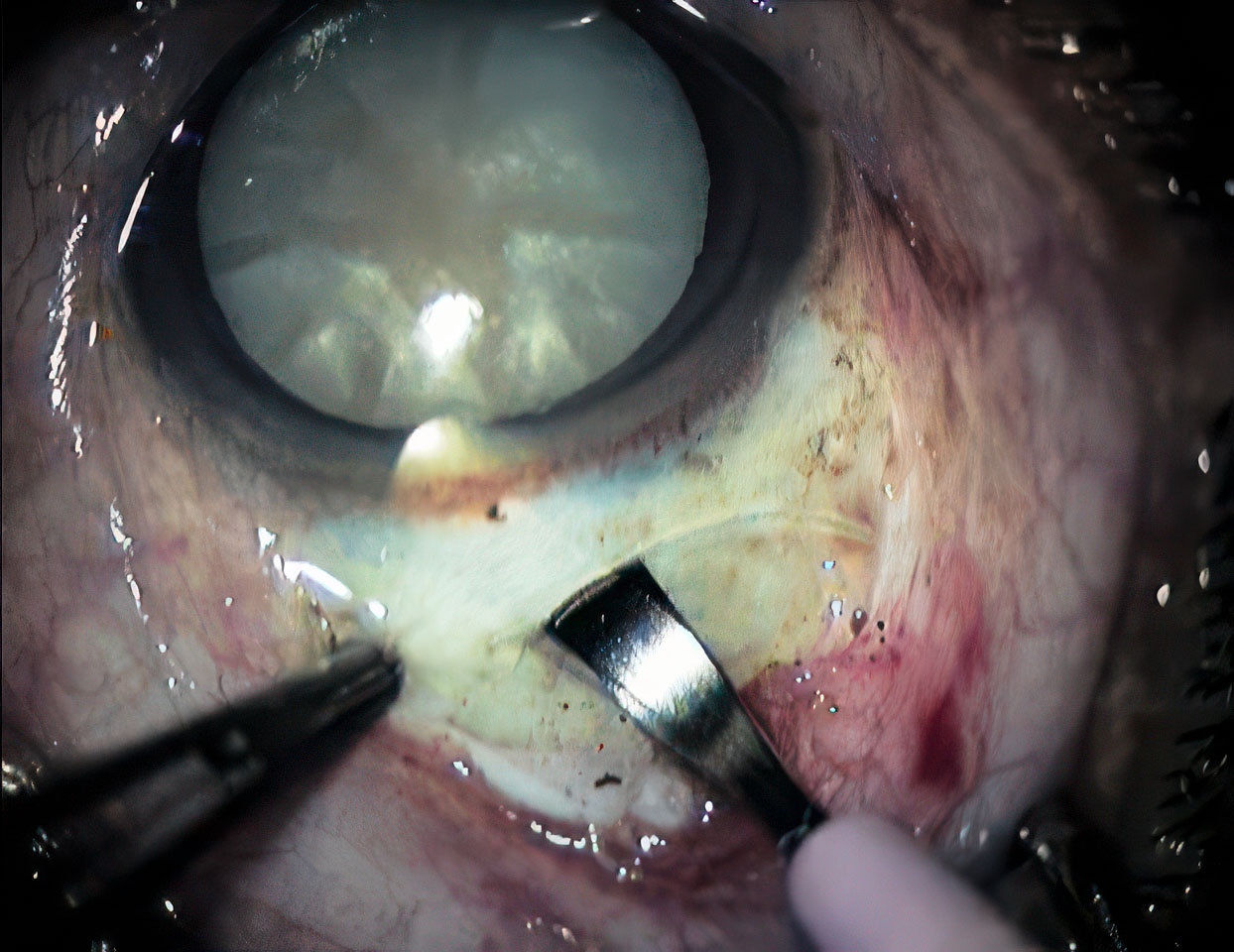 Manual small-incision cataract surgery (MSICS): techniques and tips to ...